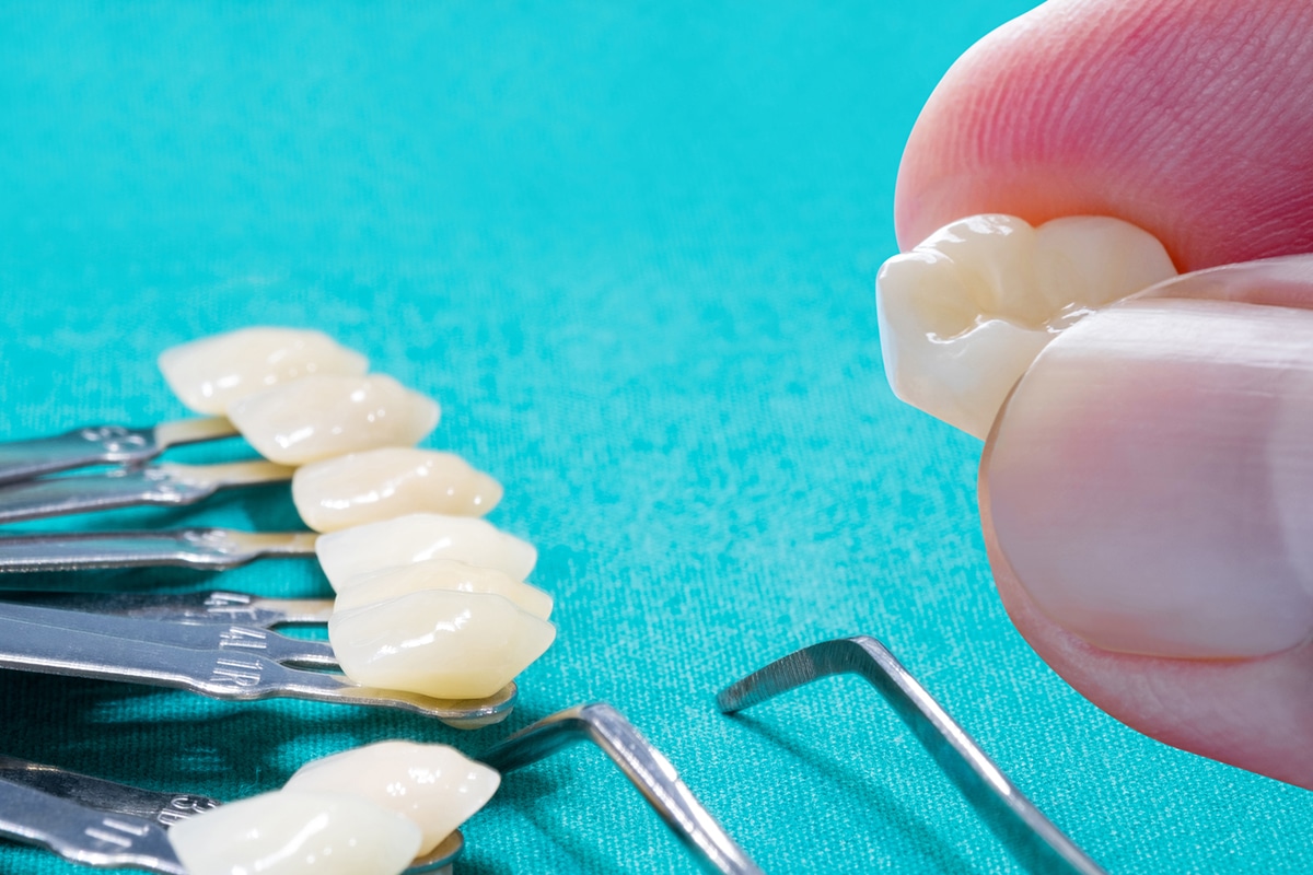 How Do Same Day Crowns Compare to Traditional Crowns in Strength? - Oak ...