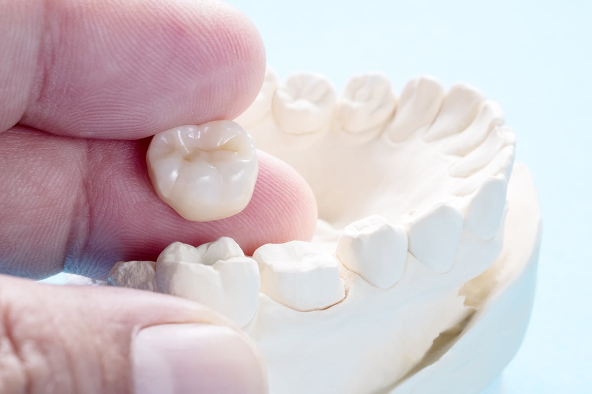 What If There Is Not Enough Tooth For A Crown? | Snellville, GA